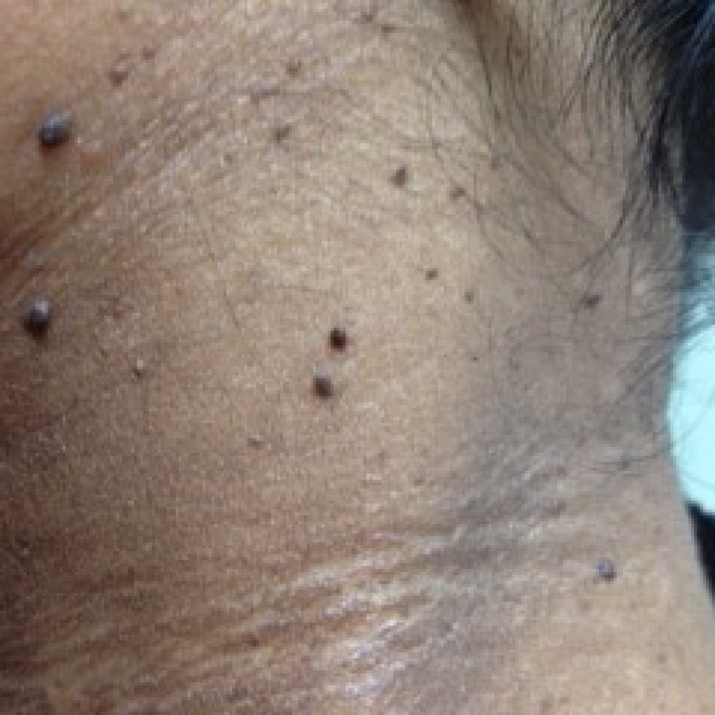 Lamprobe - Valley Medical Aesthetics